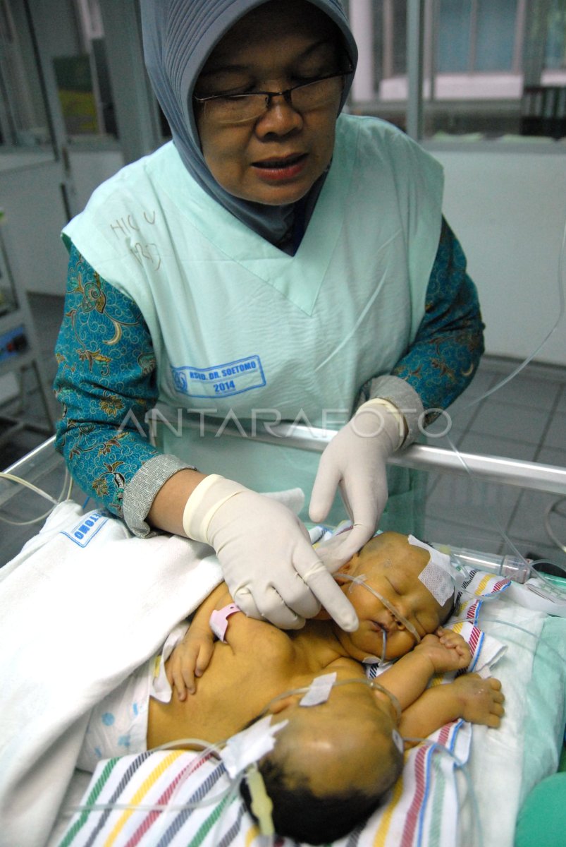 BAYI KEMBAR SIAM SURABAYA | ANTARA Foto
